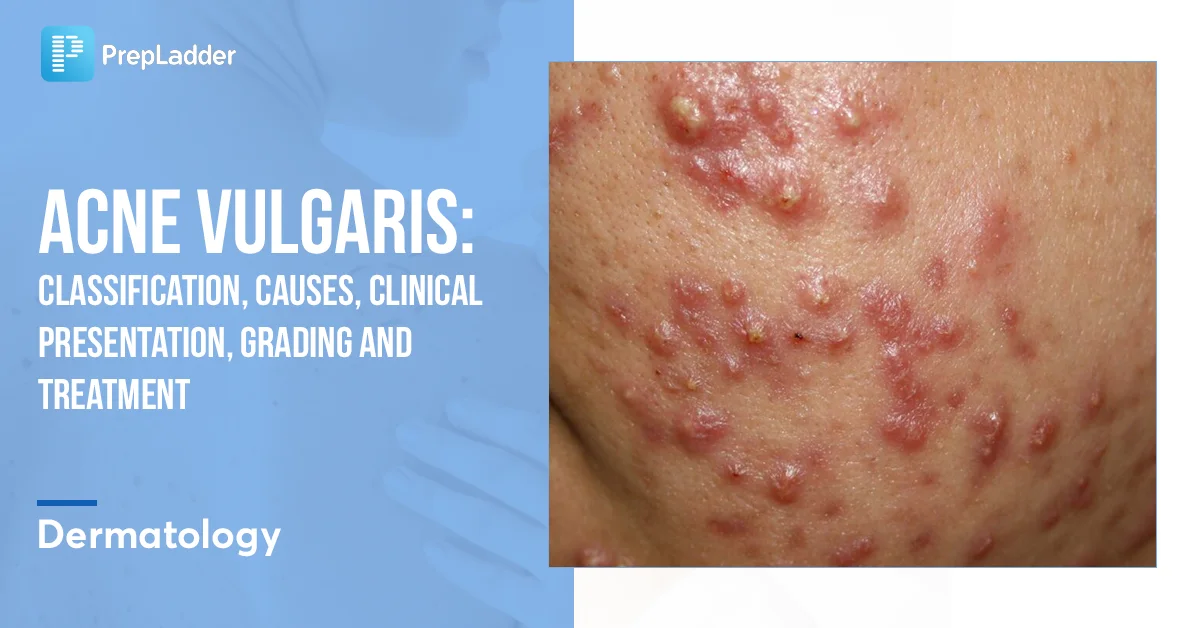 Acne Vulgaris Causes Pathogenesis Influencing Factors 40 OFF