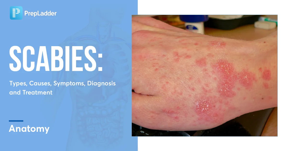 Scabies Guide Causes Symptoms And Treatment Options TSMA Scabies Guide Causes Symptoms And Treatment Options TSMA