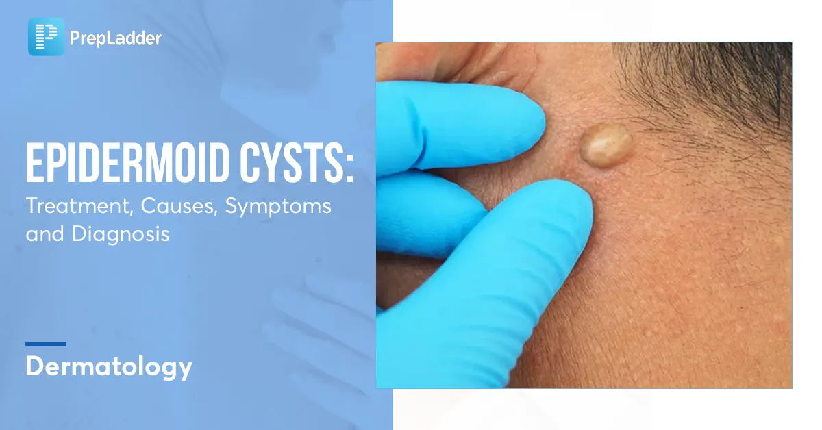 Epidermoid Cysts Treatment Causes Symptoms Diagnosis More Epidermoid Cysts Treatment Causes Symptoms Diagnosis More