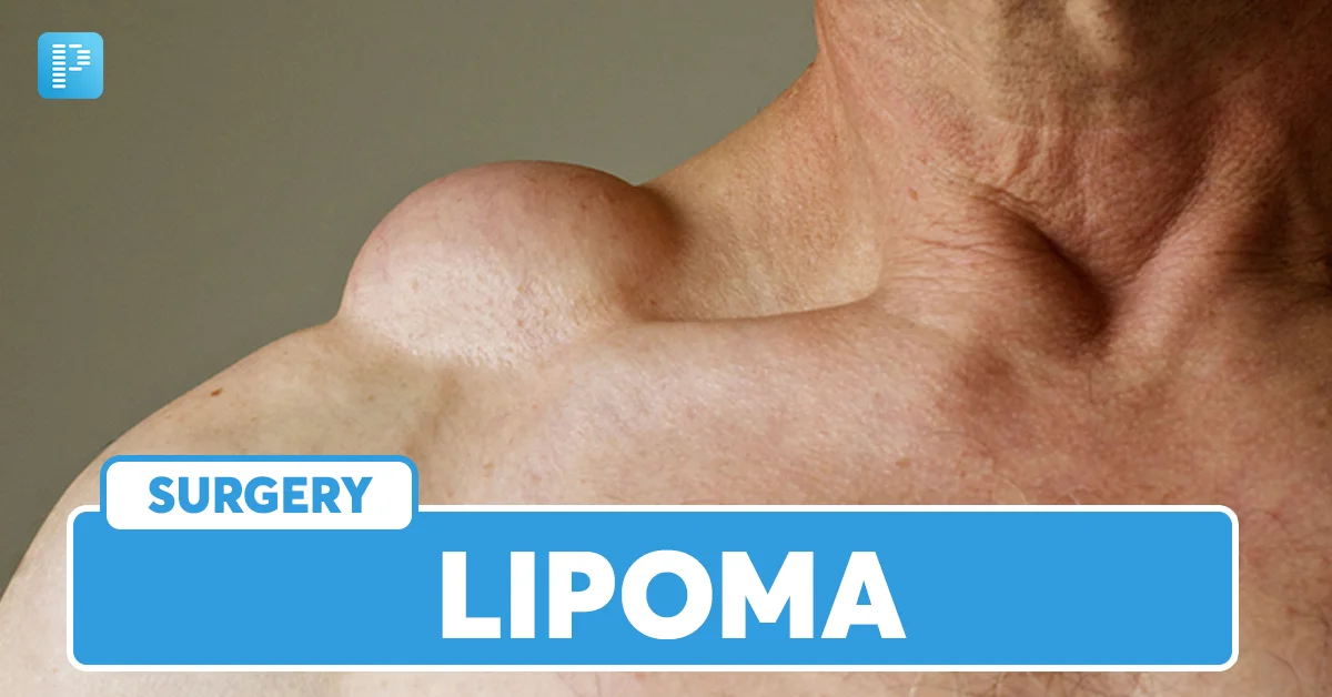 Lipoma Lipoma