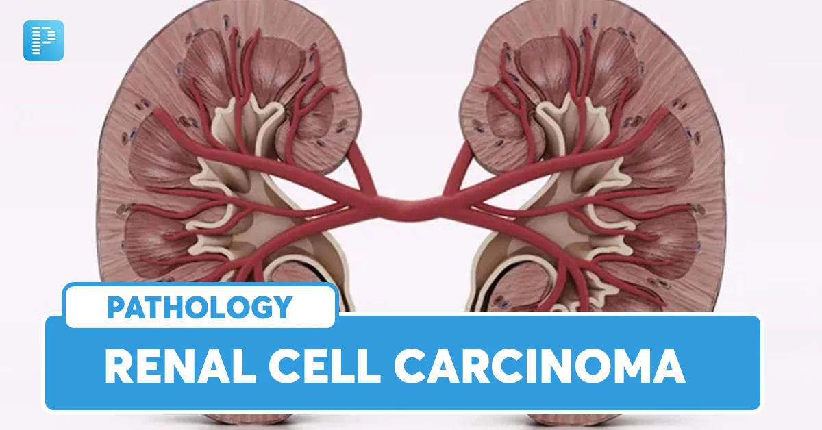 Comprehensive Guide To Renal Cell Carcinoma Comprehensive Guide To Renal Cell Carcinoma